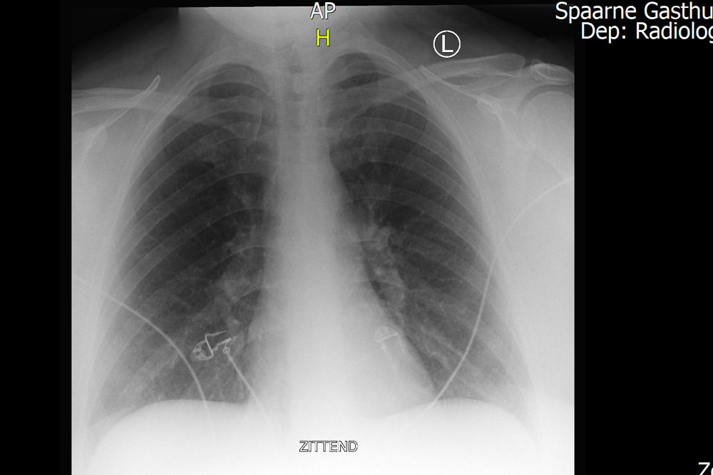 Longembolie / Longembolie Oorzaken Symptomen Diagnose En Behandeling ...